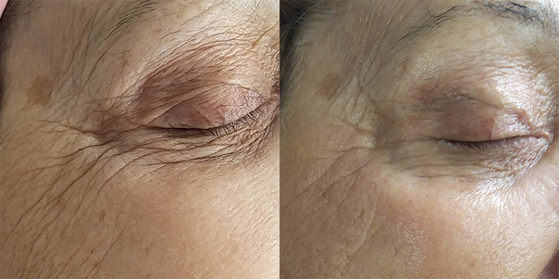 Microneedling Around The Eyes - New You Beauty